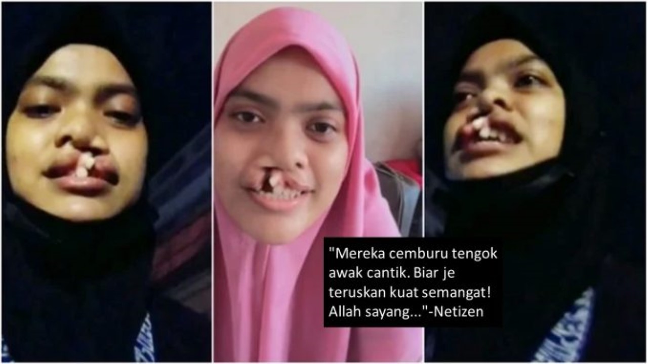 Kenapa ramai tengok saya? Selalu dipandang pelik, gadis sumbing luah ...